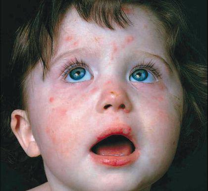 Cum iti protejezi copiii de rujeola, oreion si rubeola | Antena 1