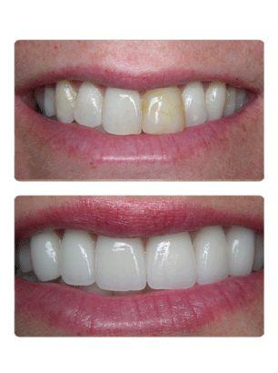 Pivoti de sticla pentru dinti mai sanatosi si mai frumosi | Antena 1