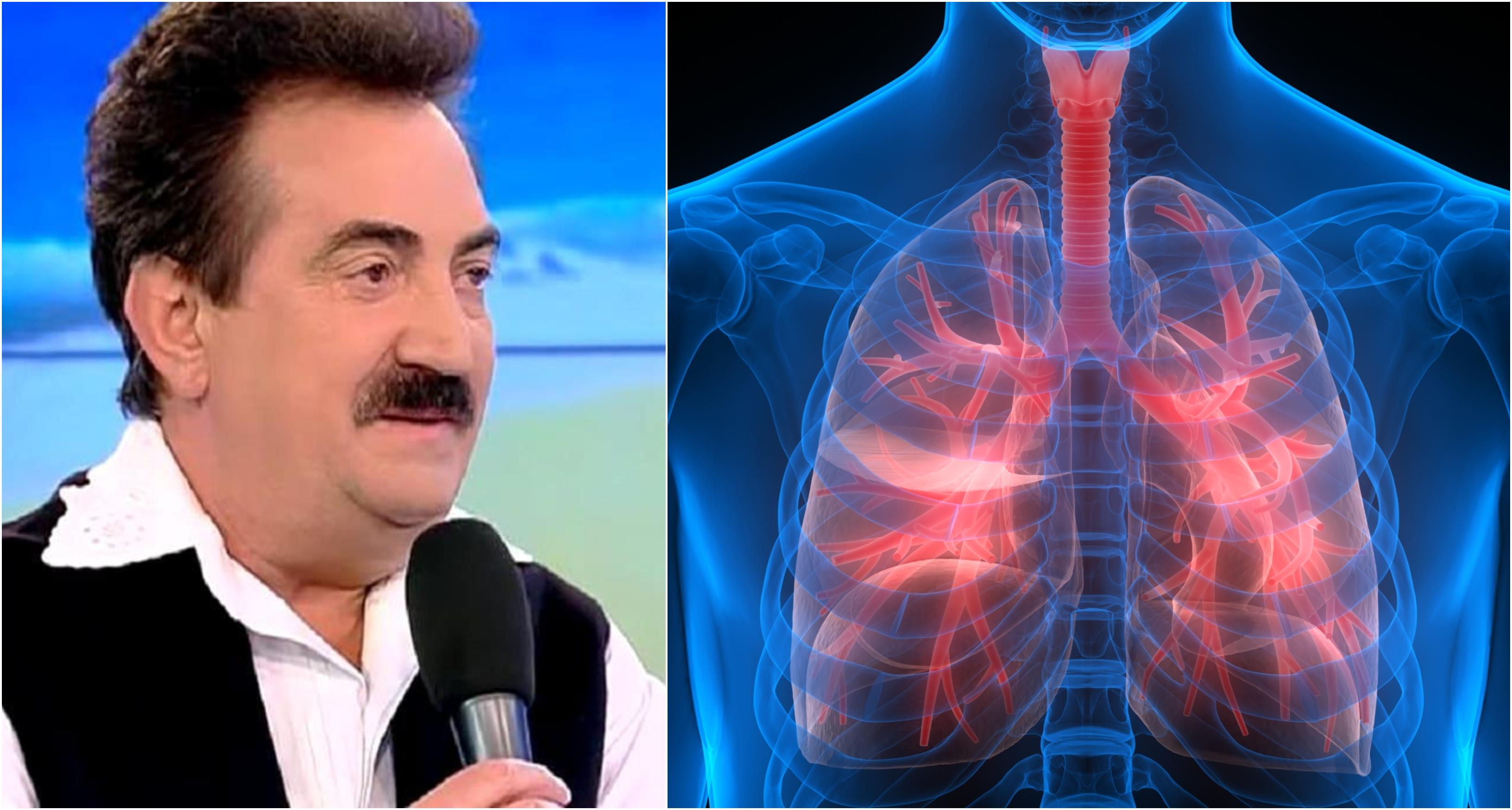 Ce înseamnă "contuzie pulmonară", afecțiunea în urma căreia Petrică ...